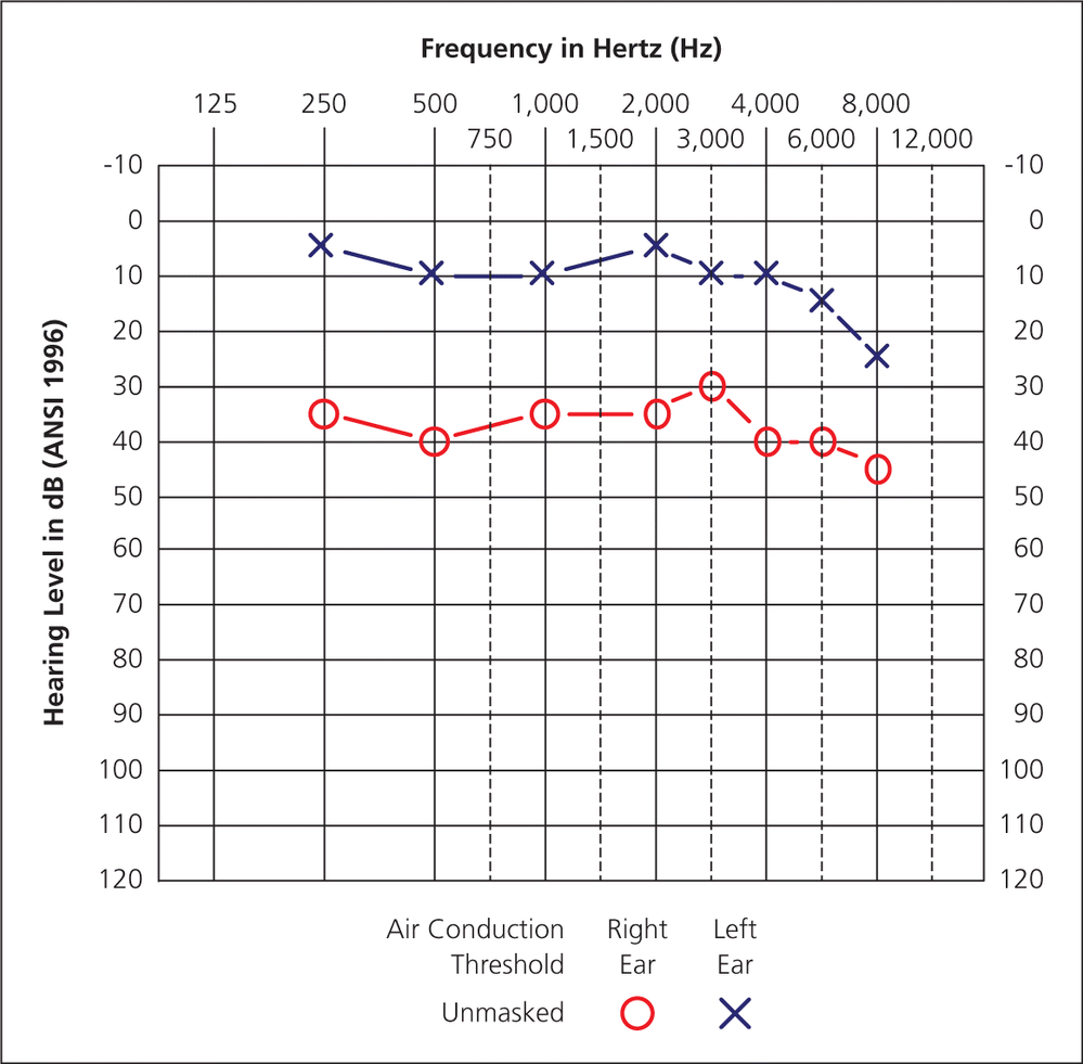 How to Read an Audiogram - Lessons in Speech with Nanette